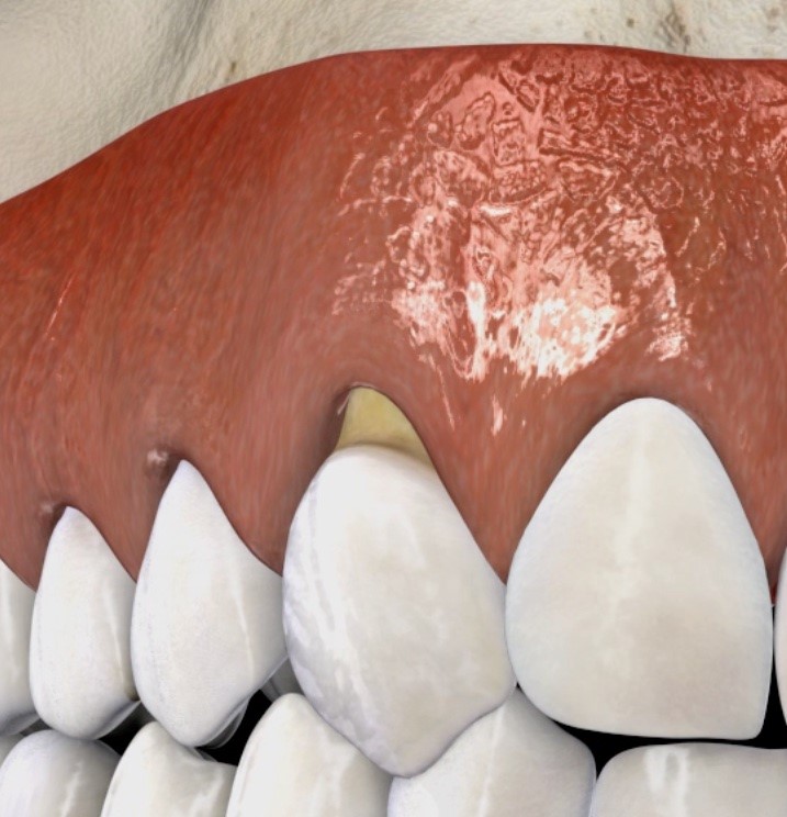 Regenerarea gingivală: Soluția pentru problemele gingivale | Respiro ...